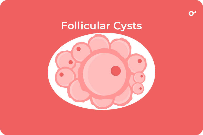 Do ovarian cysts lower your chances of pregnancy? - Inito