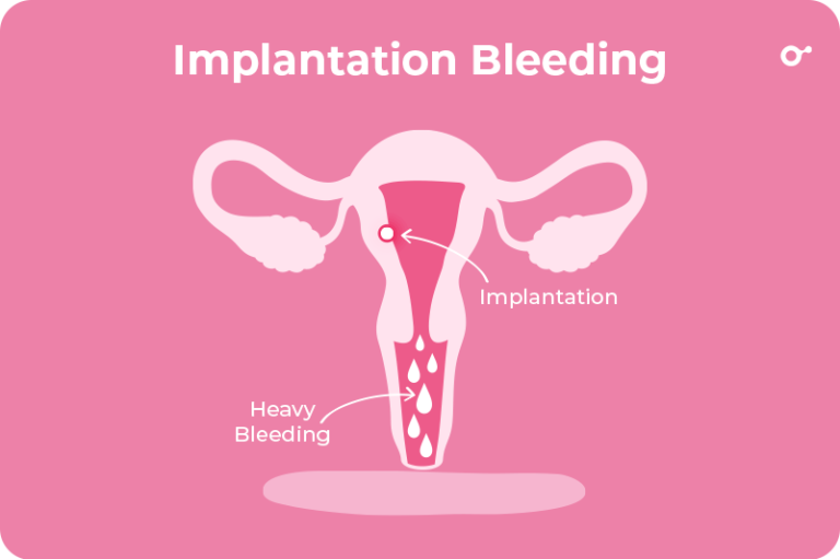 Is Heavy Implantation Bleeding Normal?