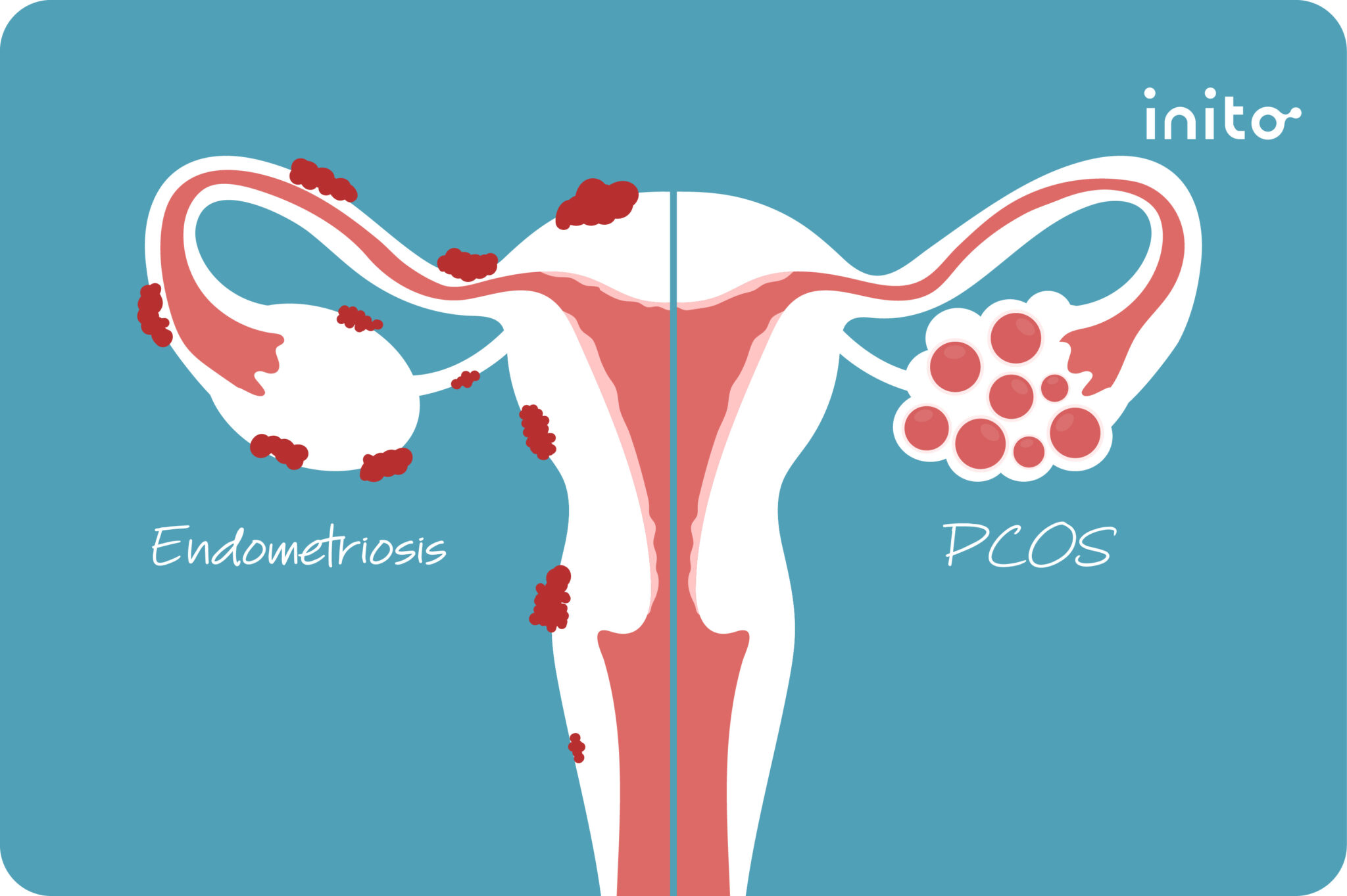 Endometriosis vs PCOS: How to Tell The Difference - Inito